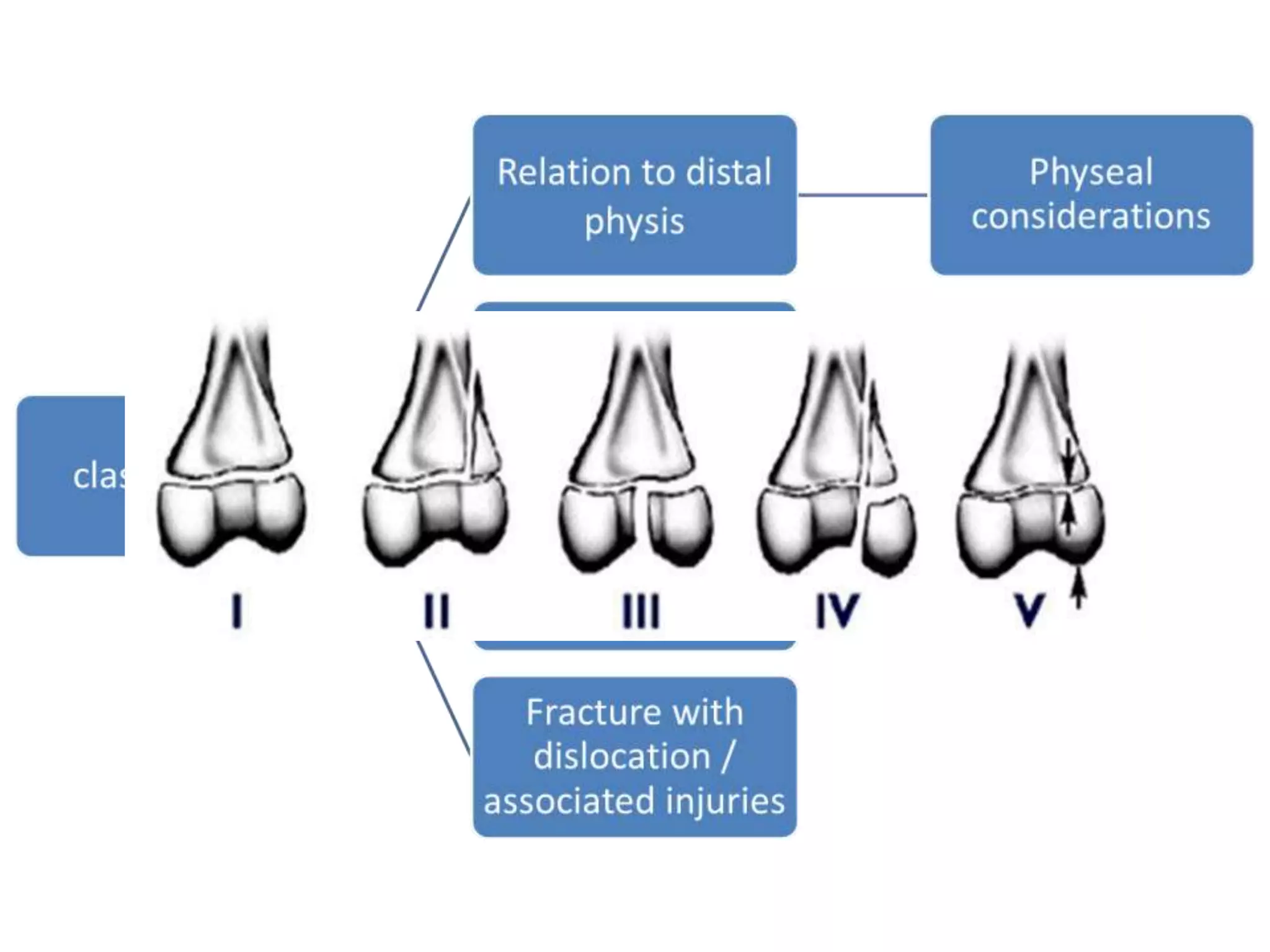 Principle management fracture forearm (shaft and distal end radius) in ...