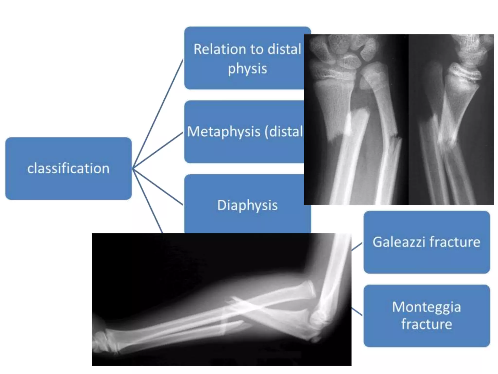Principle management fracture forearm (shaft and distal end radius) in ...