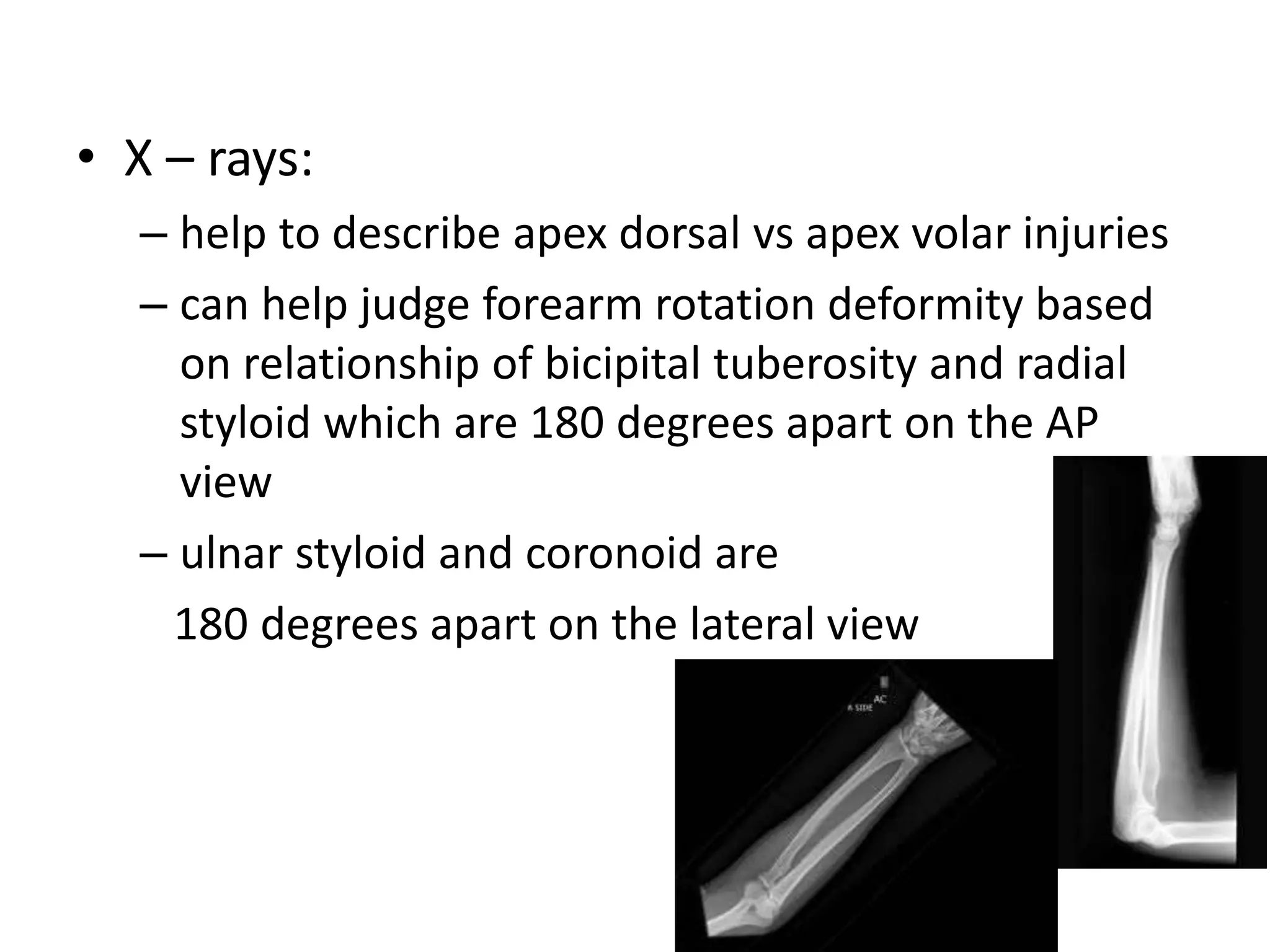 Principle management fracture forearm (shaft and distal end radius) in ...