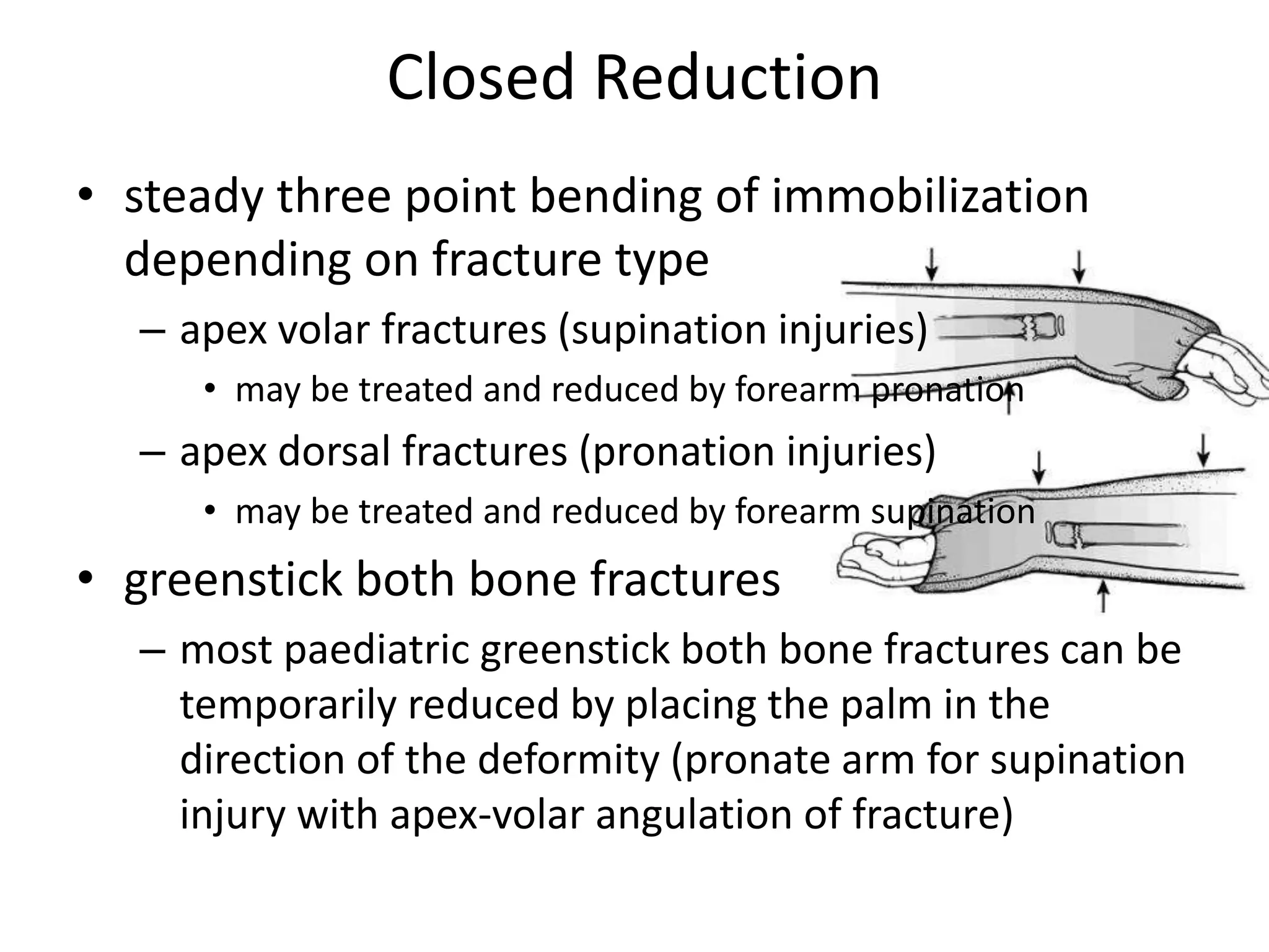 Principle management fracture forearm (shaft and distal end radius) in ...