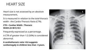 Principle of CXR reading Dr. Azande.pptx