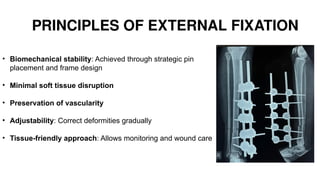 PRINCIPLE OF EXTERNAL FIXATOR orthopaedics | PPTX