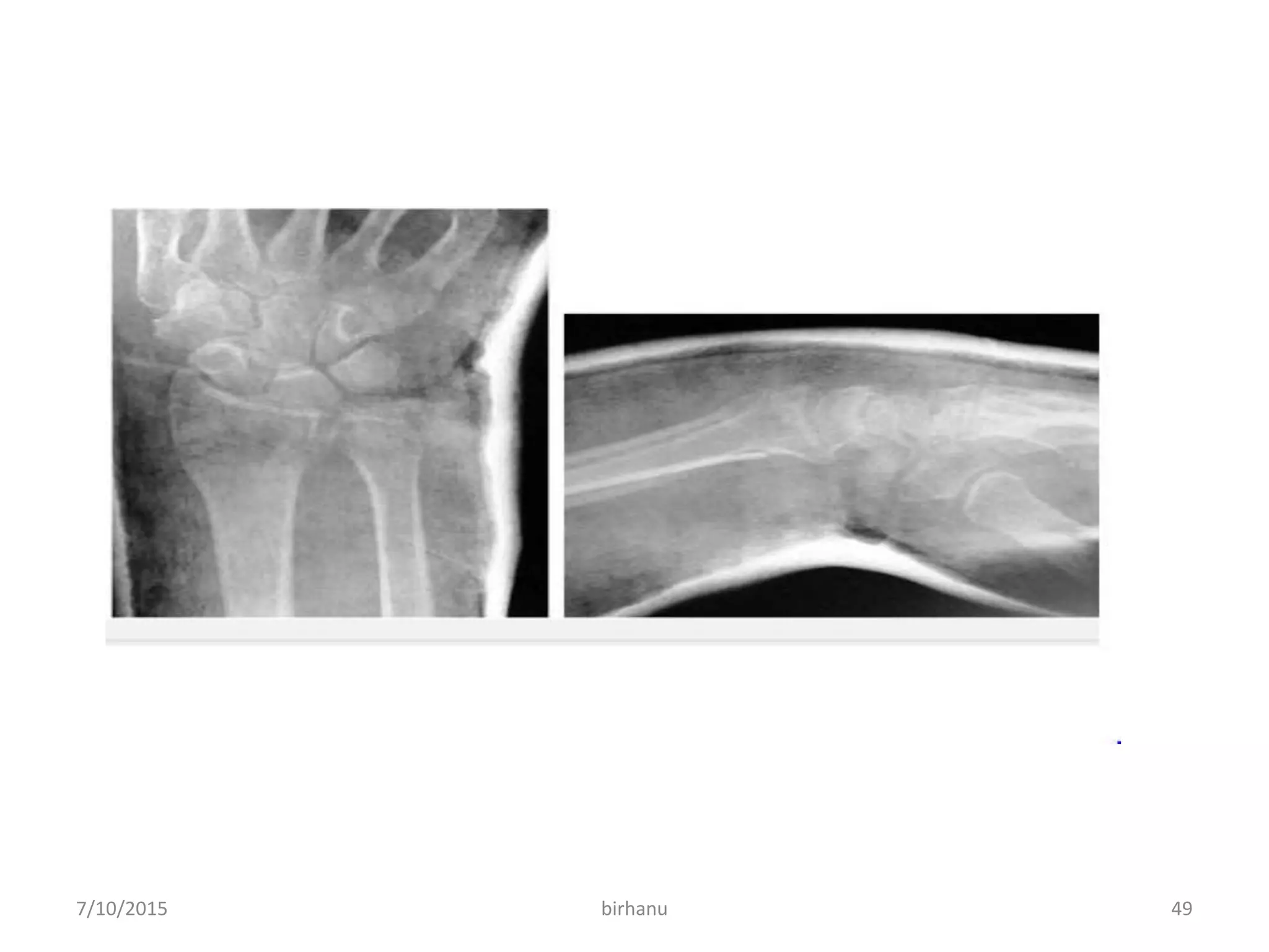 Principle of fracture managment | PPTX
