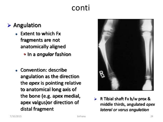 Principle of fracture managment