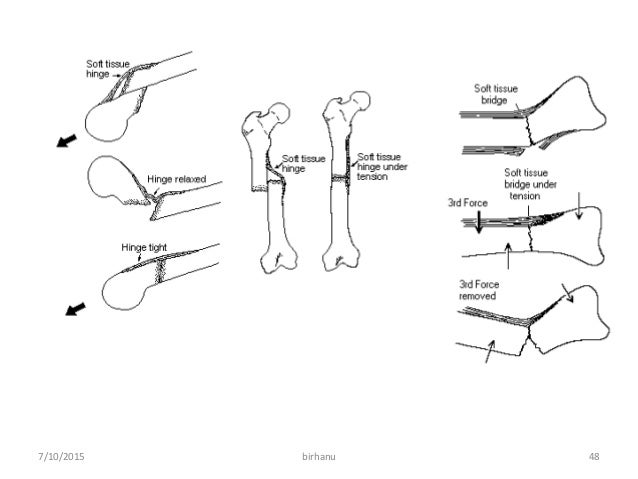 Principle of fracture managment