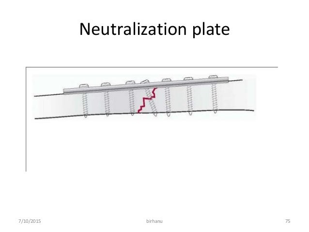 Principle of fracture managment
