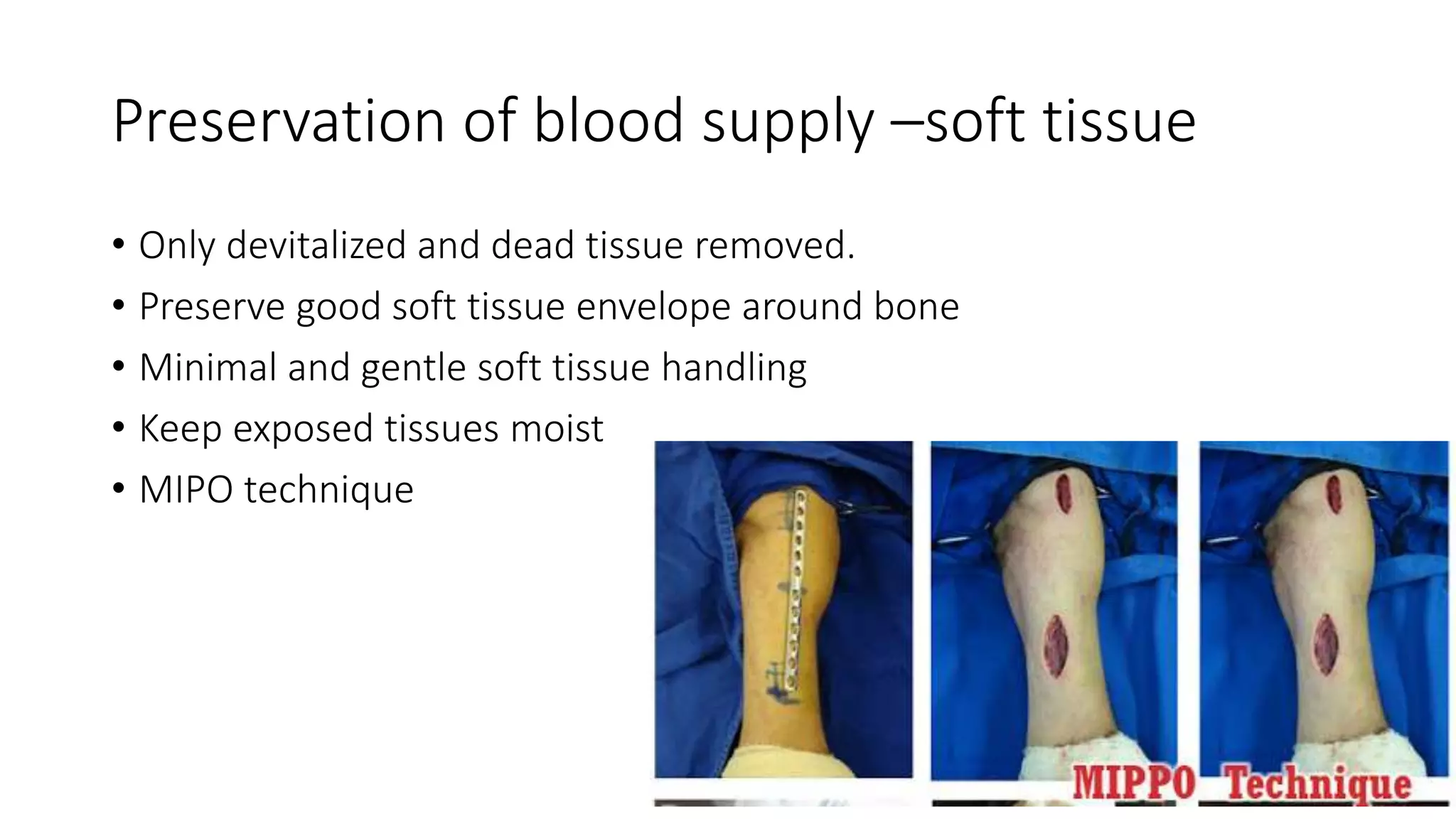 Principle of internal and external fixation slideshare | PPTX