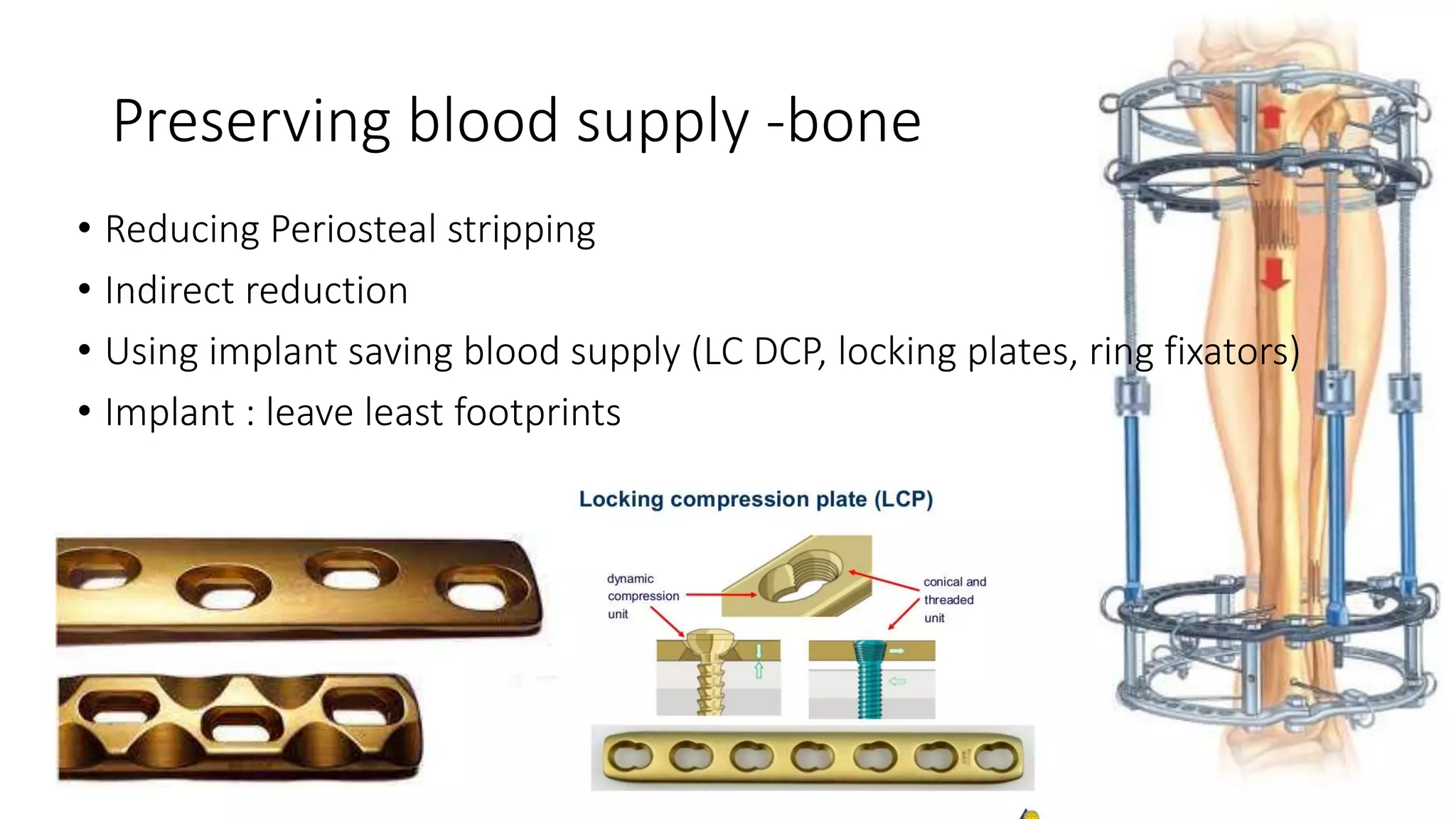 Principle of internal and external fixation slideshare | PPTX