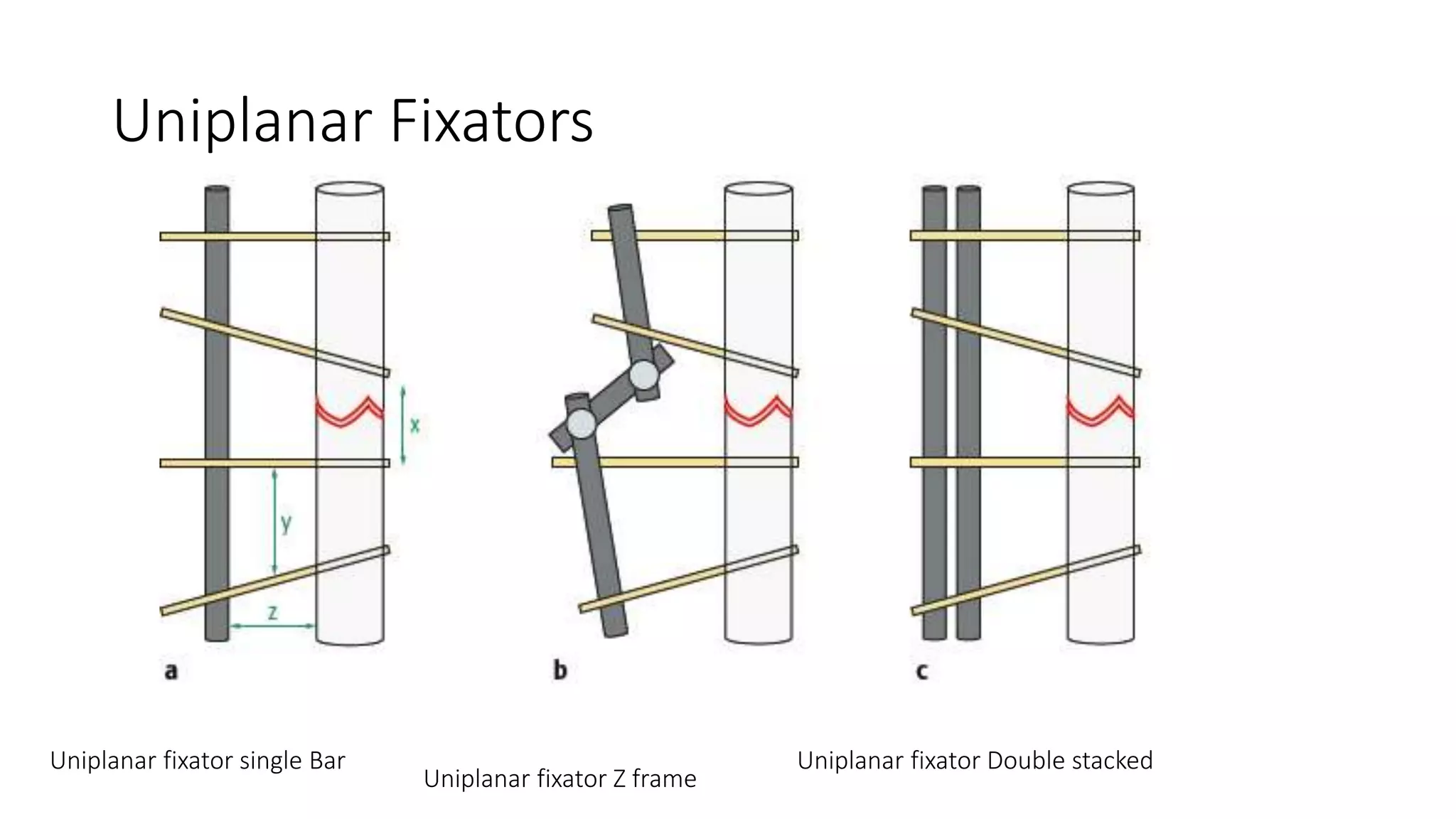 Principle of internal and external fixation slideshare | PPTX