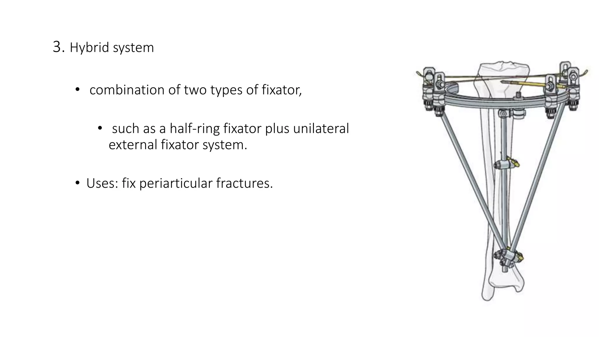 Principle of internal and external fixation slideshare | PPTX
