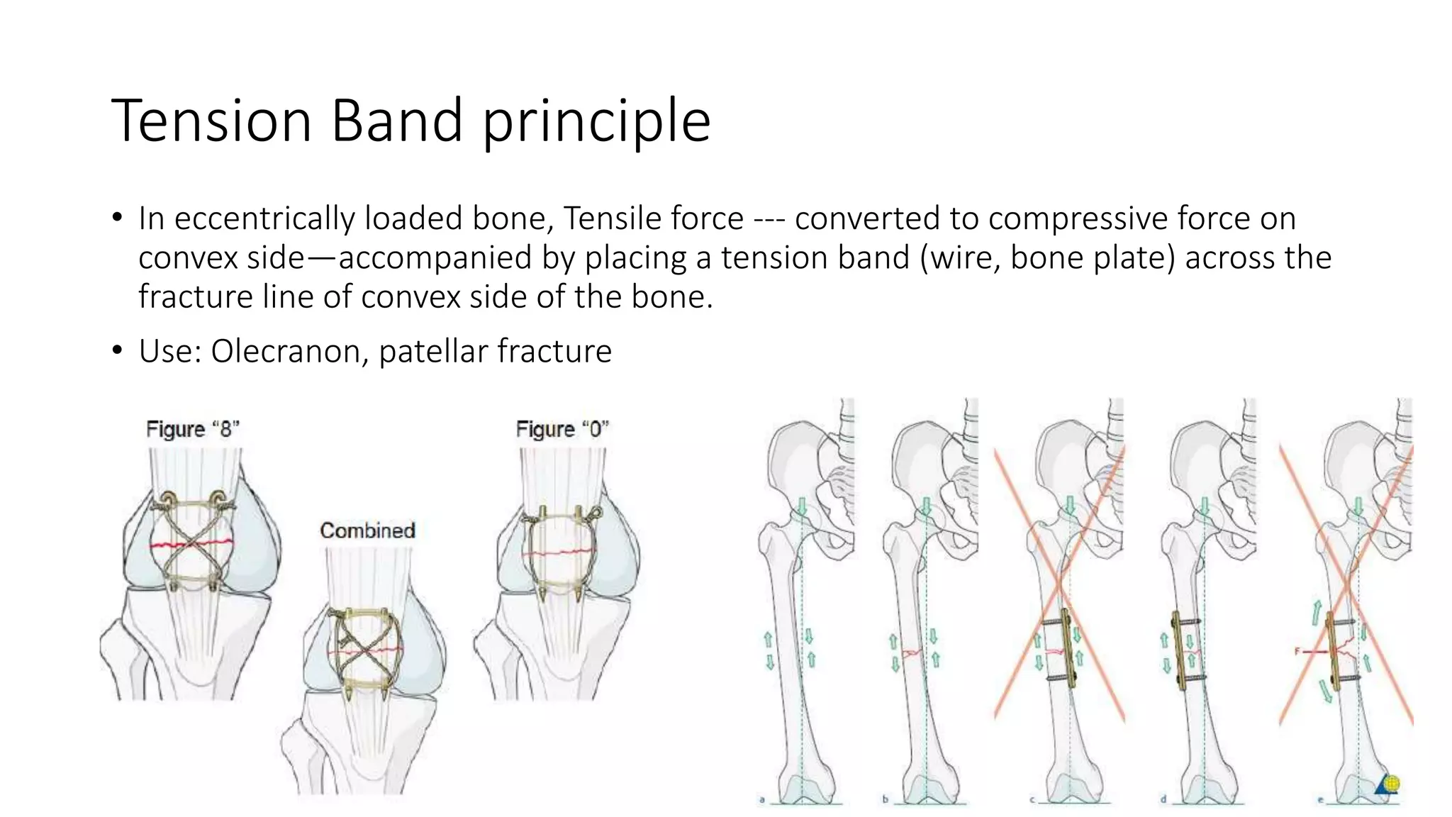 Principle of internal and external fixation slideshare | PPTX