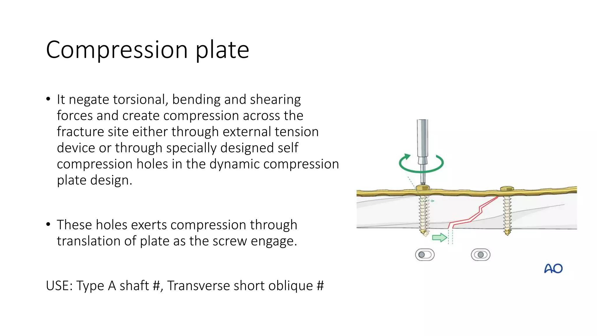 Principle of internal and external fixation slideshare | PPTX