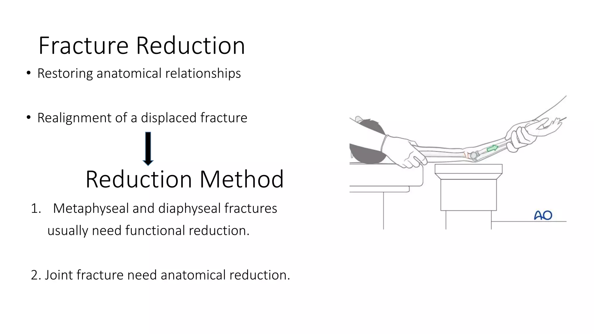 Principle of internal and external fixation slideshare | PPTX