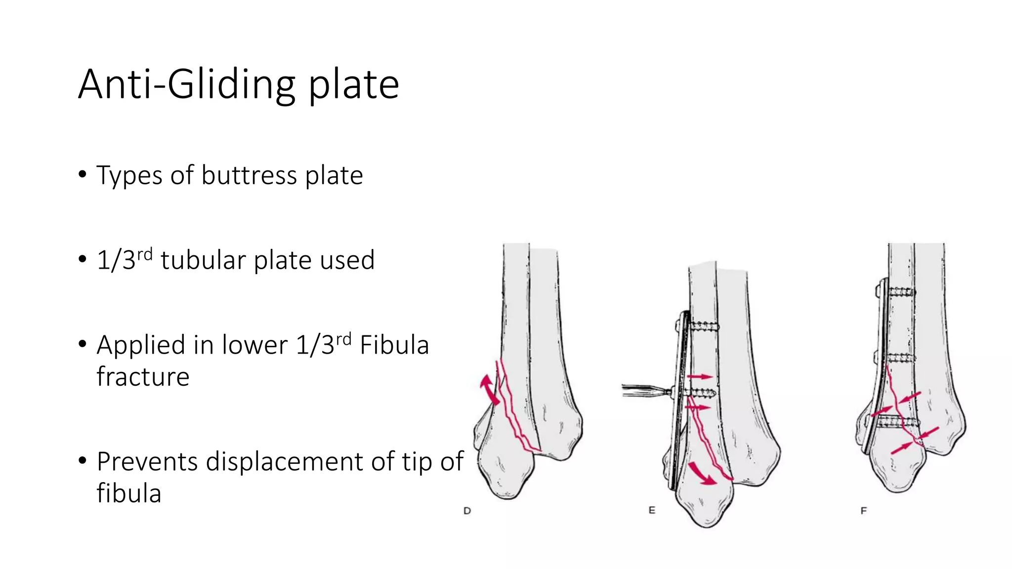 Principle of internal and external fixation slideshare | PPTX