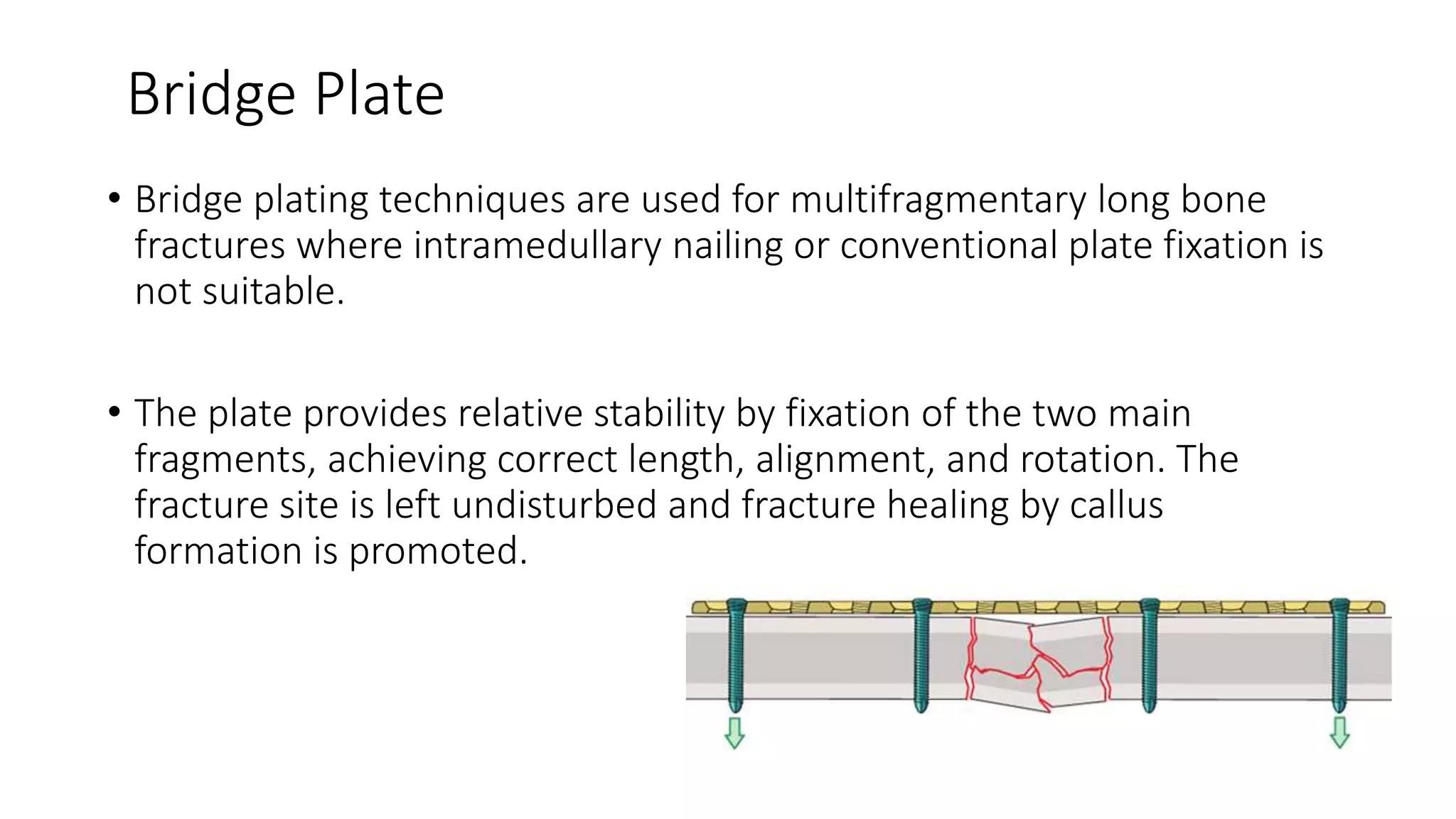 Principle of internal and external fixation slideshare | PPTX