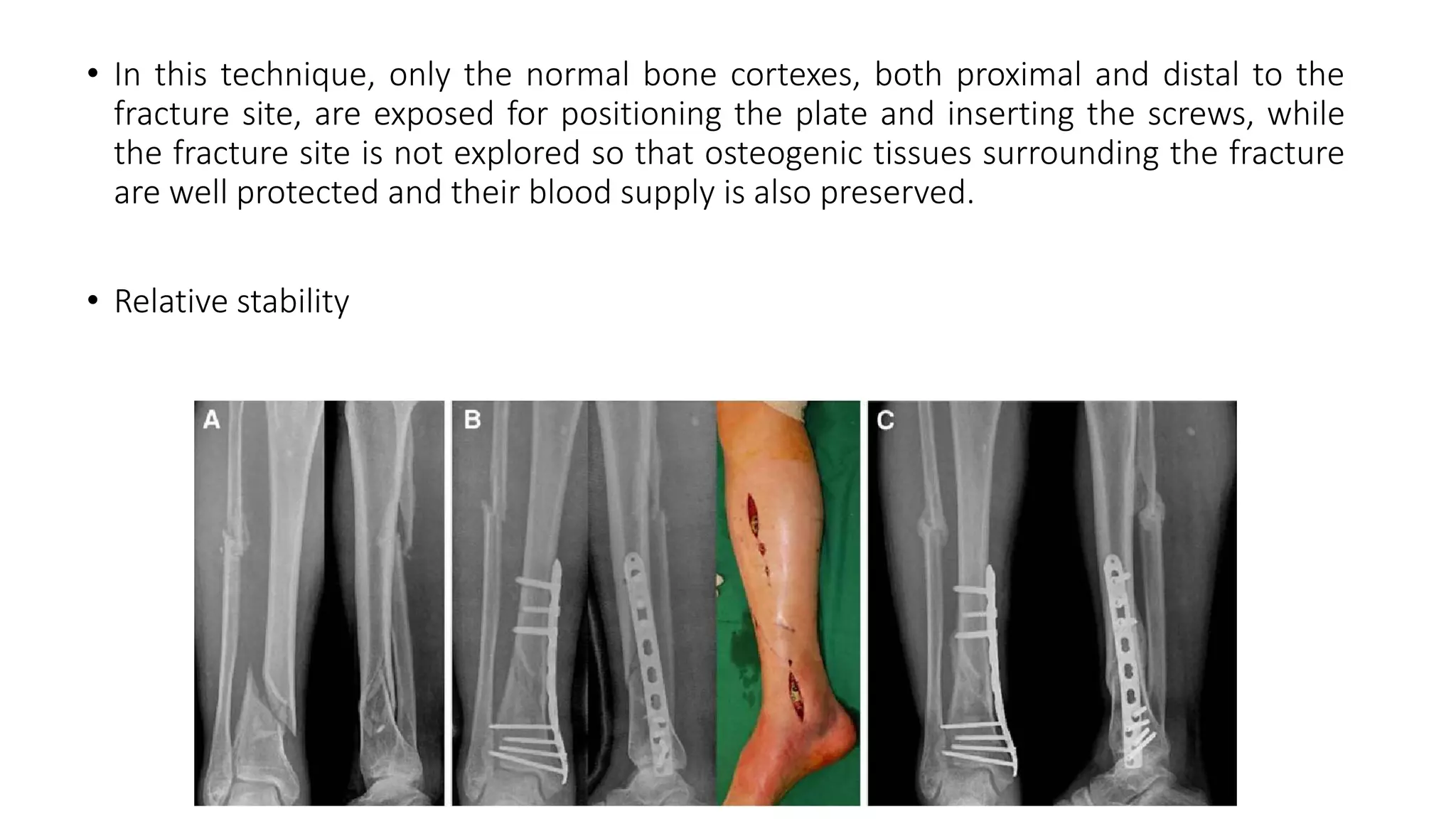 Principle of internal and external fixation slideshare | PPTX