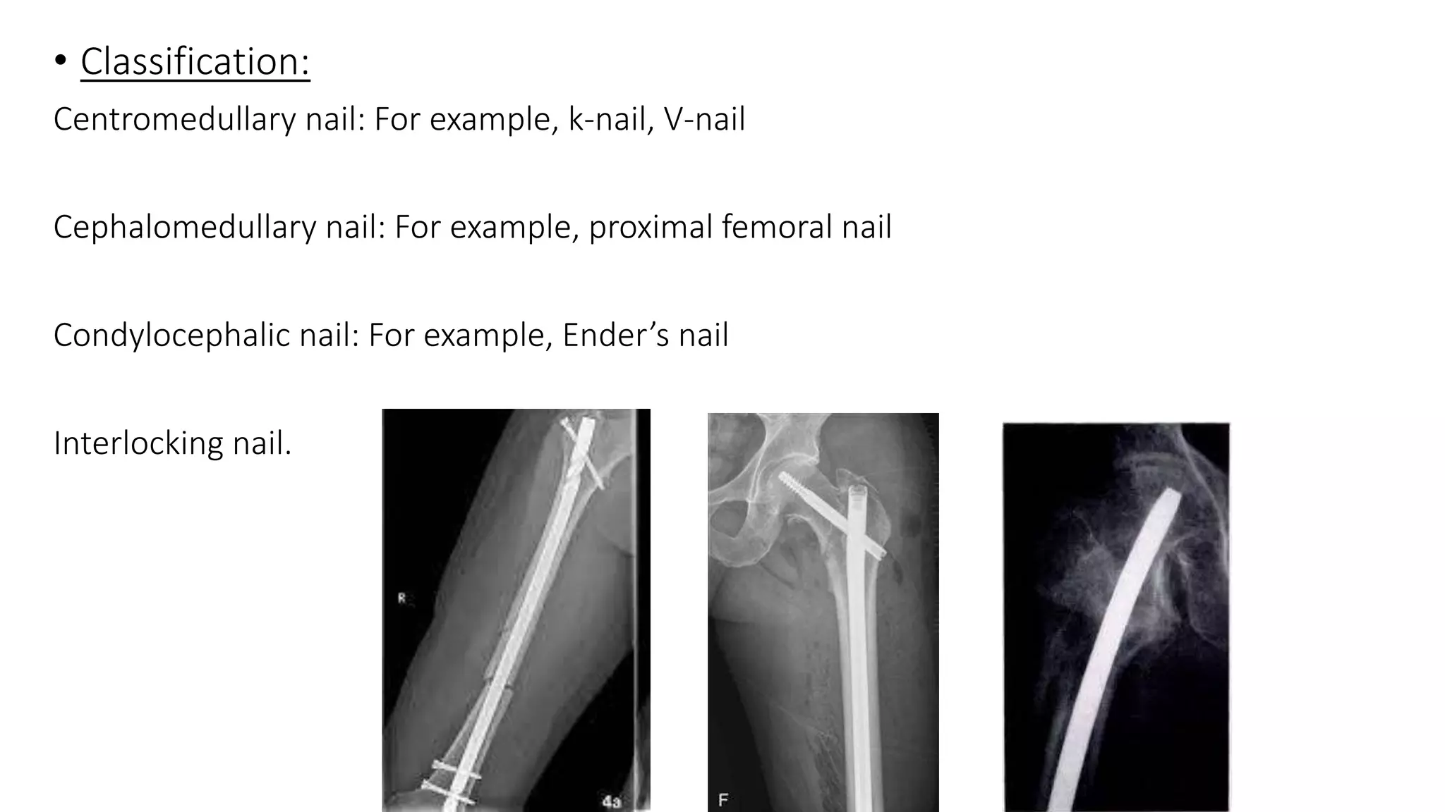 Principle of internal and external fixation slideshare | PPTX