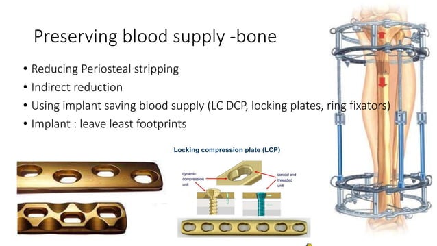 Principle of internal and external fixation slideshare | PPTX | First ...