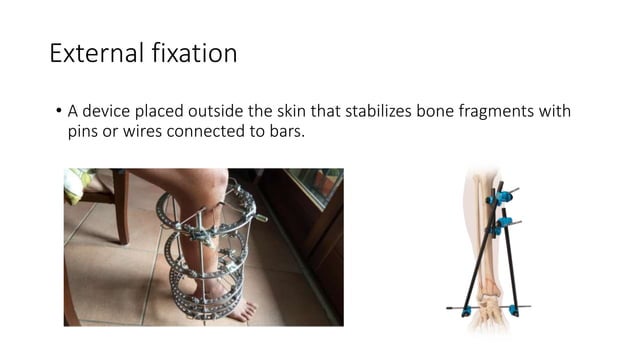 Principle of internal and external fixation slideshare | PPTX | First ...
