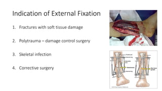 Principle of internal and external fixation slideshare | PPTX