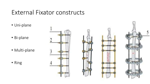Principle of internal and external fixation slideshare | PPTX | First ...