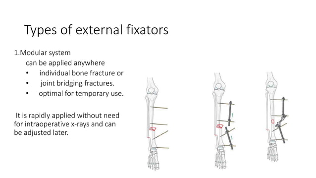 Principle of internal and external fixation slideshare | PPTX | First ...