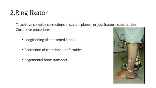 Principle of internal and external fixation slideshare | PPTX | First ...