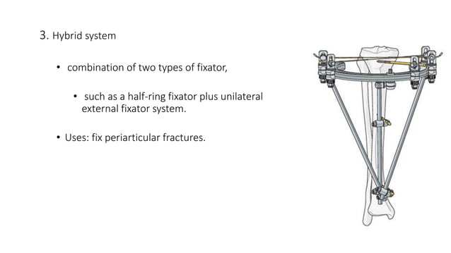 Principle of internal and external fixation slideshare | PPTX | First ...