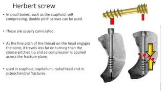 Principle of internal and external fixation slideshare | PPTX