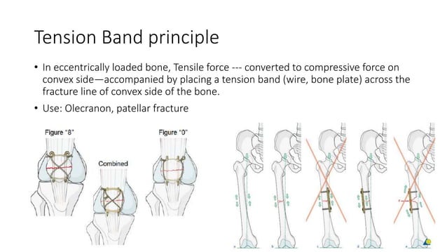 Principle of internal and external fixation slideshare | PPTX | First ...