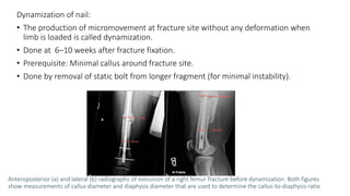 Principle of internal and external fixation slideshare | PPTX