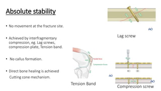 Principle of internal and external fixation slideshare | PPTX