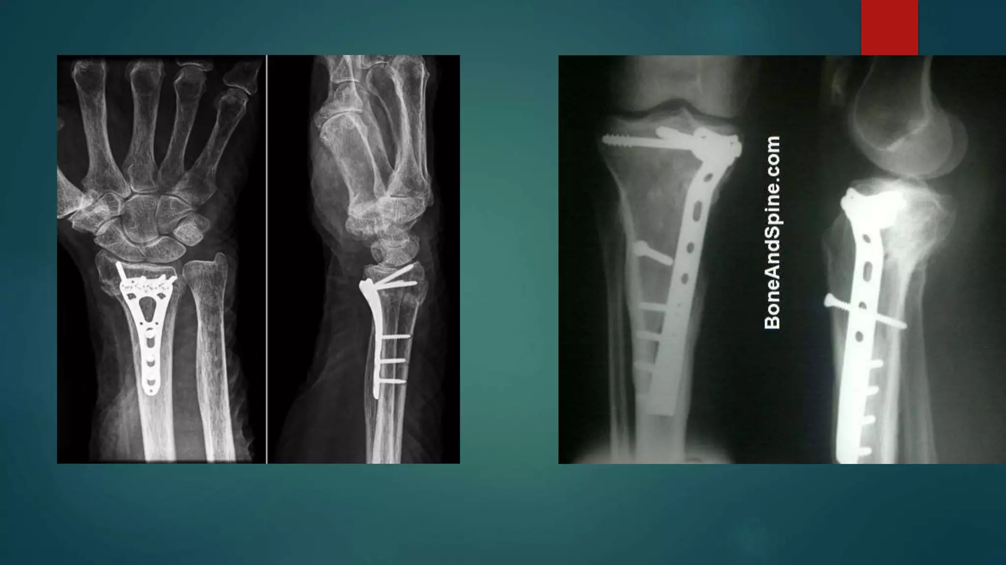 Principle of internal fixation | PPTX