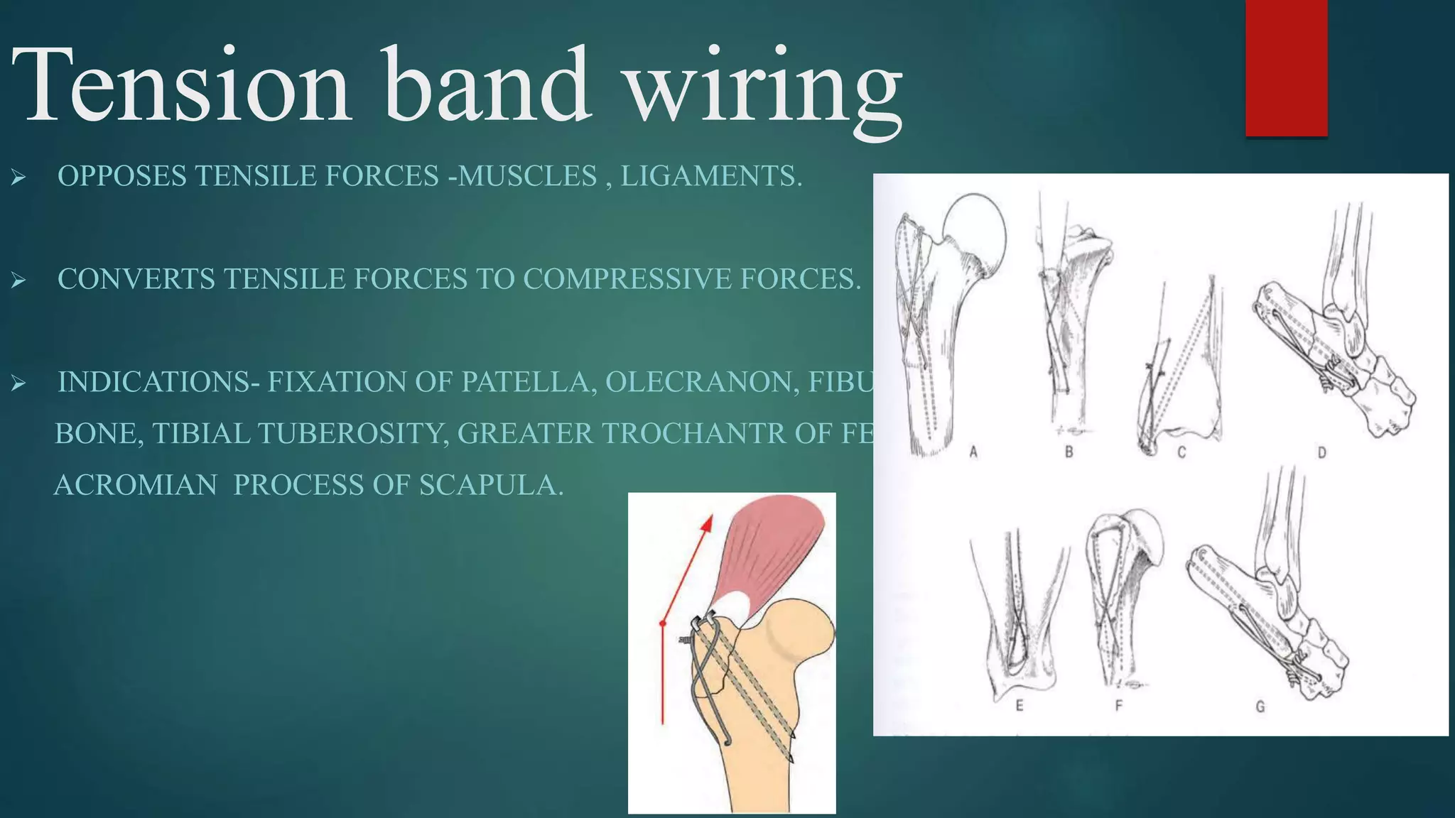 Principle of internal fixation | PPTX