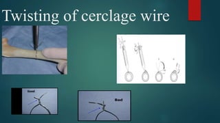 Principle of internal fixation | PPTX