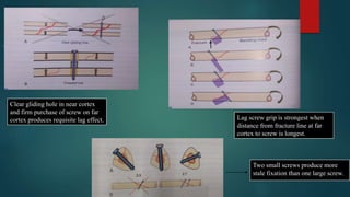 Principle of internal fixation | PPTX