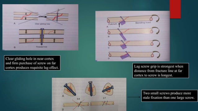 Principle of internal fixation | PPTX