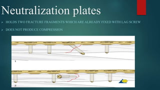 Principle of internal fixation | PPTX