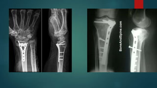 Principle of internal fixation | PPTX