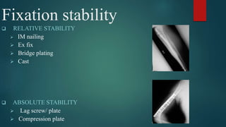 Principle of internal fixation | PPTX