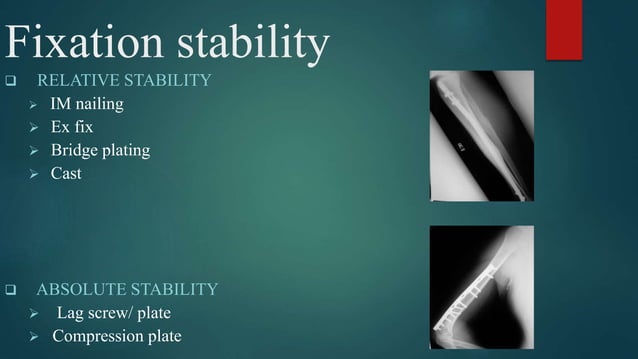 Principle of internal fixation | PPTX