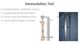 Principle of internal fixation copy | PPTX