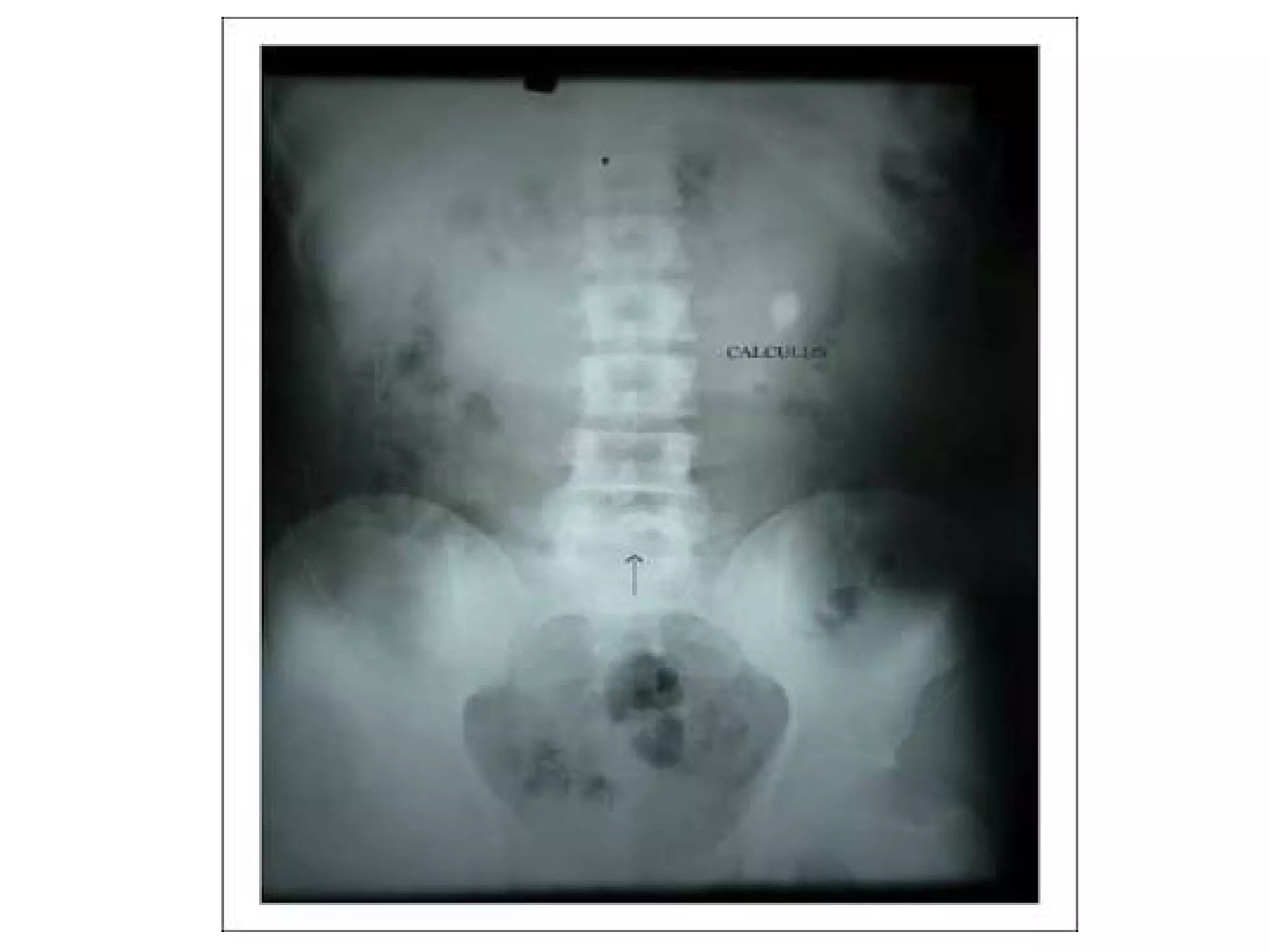Principle of management of rt flank pain | PPT