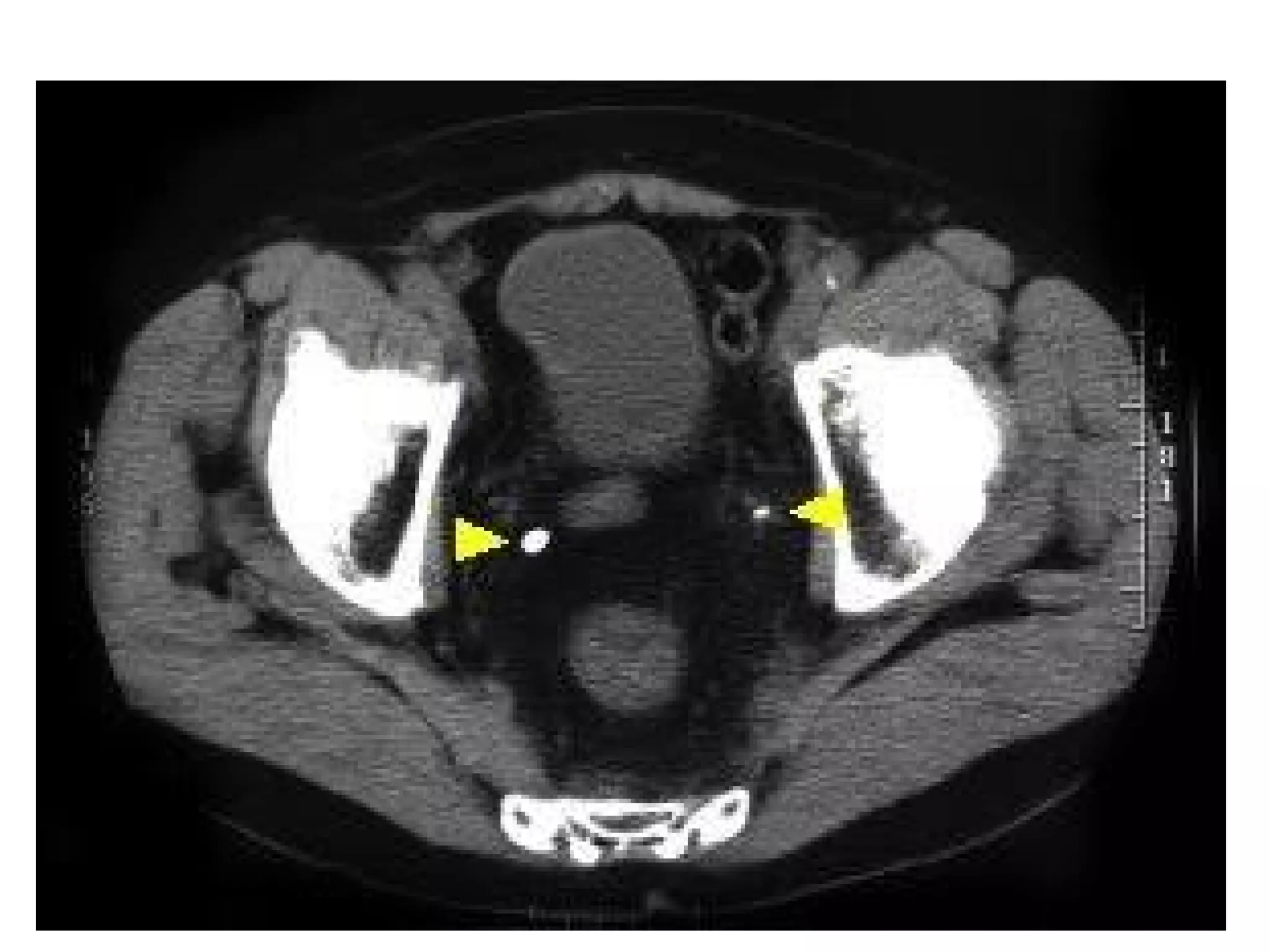 Principle of management of rt flank pain | PPT