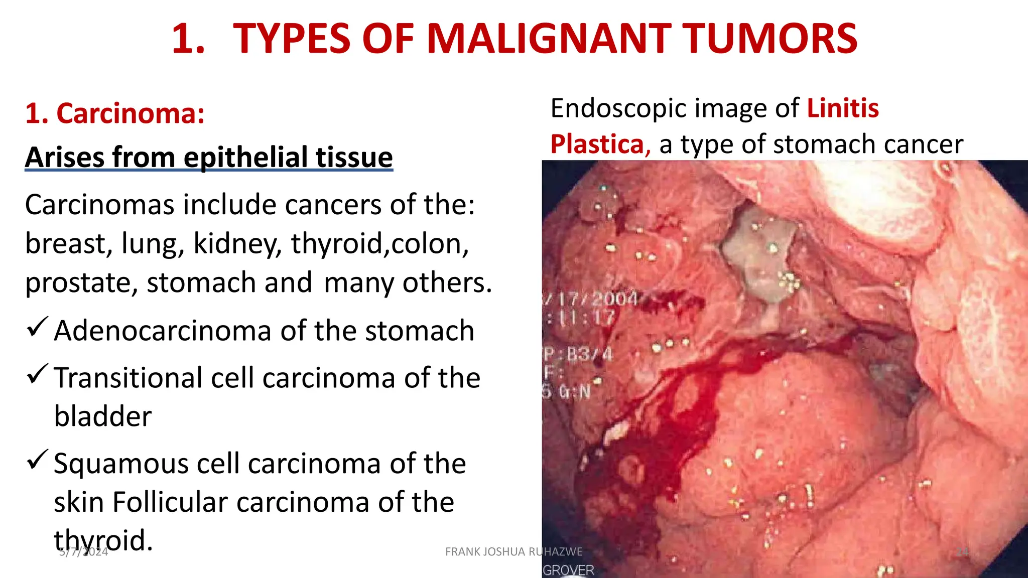 PRINCIPLES OF ONCOLOGY .pptx FRANK JOSHUA RUHAZWE | PPTX | Cancer ...