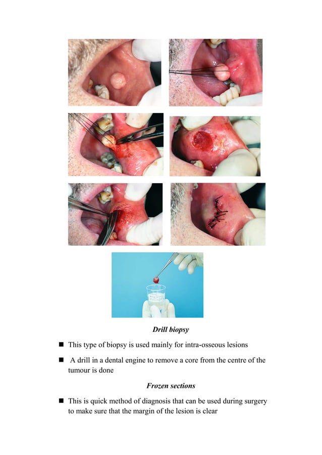 Principle of oral biopsy | PDF | Skin and Dermatology | Diseases and ...