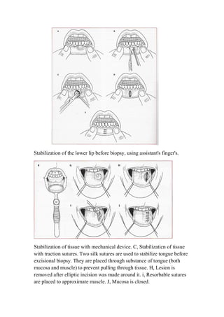 Principle of oral biopsy | PDF