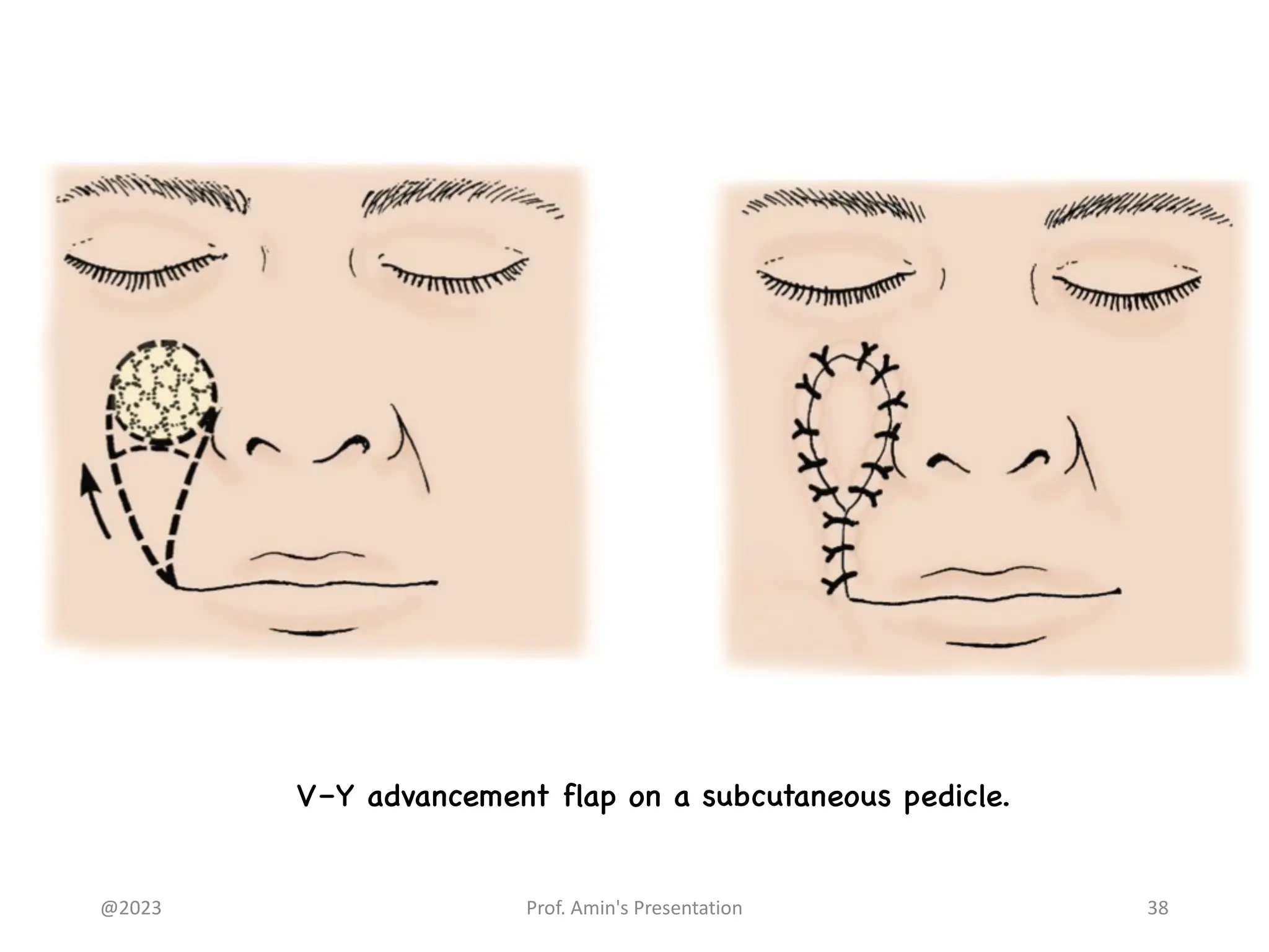Principle of Plastic Surgery, plastic surgery notes | PDF