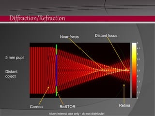 Principle of presbyopia correcting iols | PPT