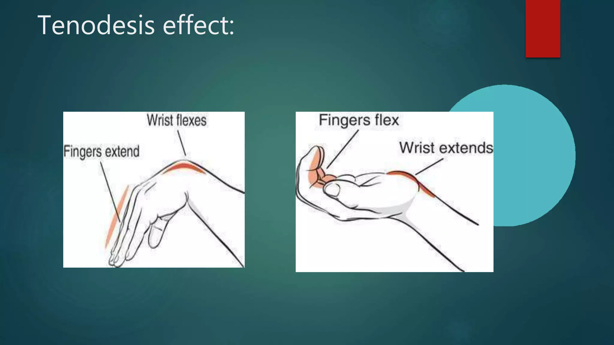 Principle of tendon transfer.pptx | Death, Injury, or Military Conflict ...